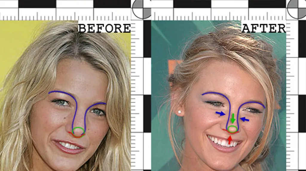 Blake Lively Before And After Nose Job
