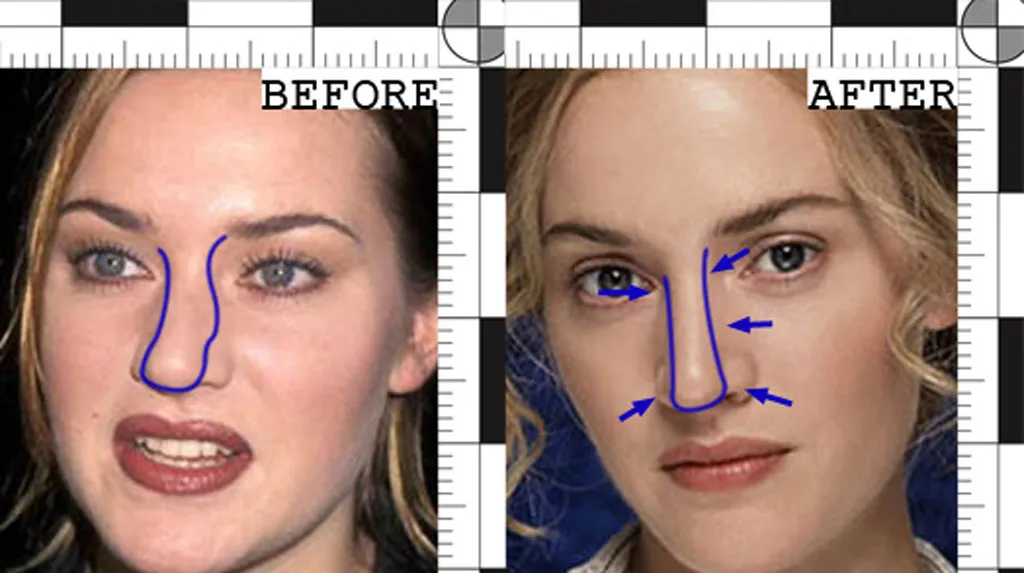 Kate Winslet and the Great Rhinoplasty Surgery Debate - Rawnsley ...